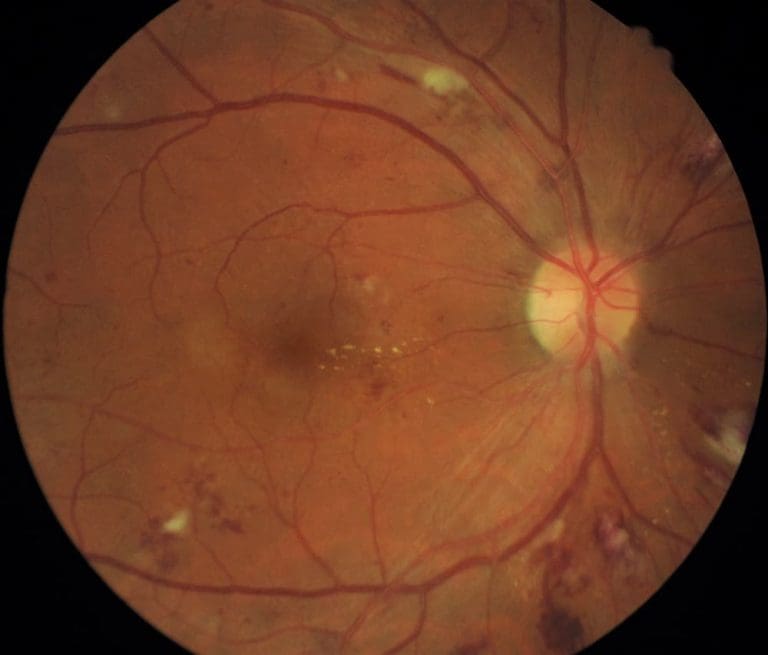 Retina - Tyson Eye | Definition & Common Disorders | Retina Naples