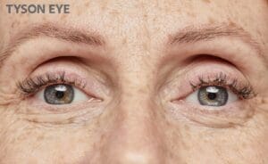 What are Common Changes to Your Eyes as You Age? - Tyson Eye